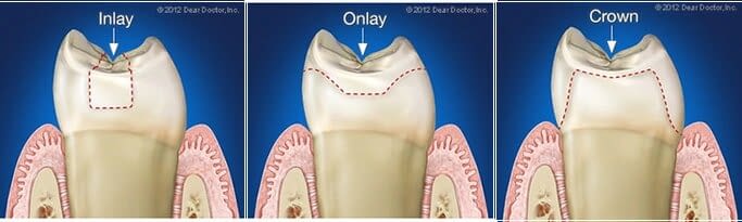 Dental Inlays & Onlays | Green Bay Cosmetic Dentistry