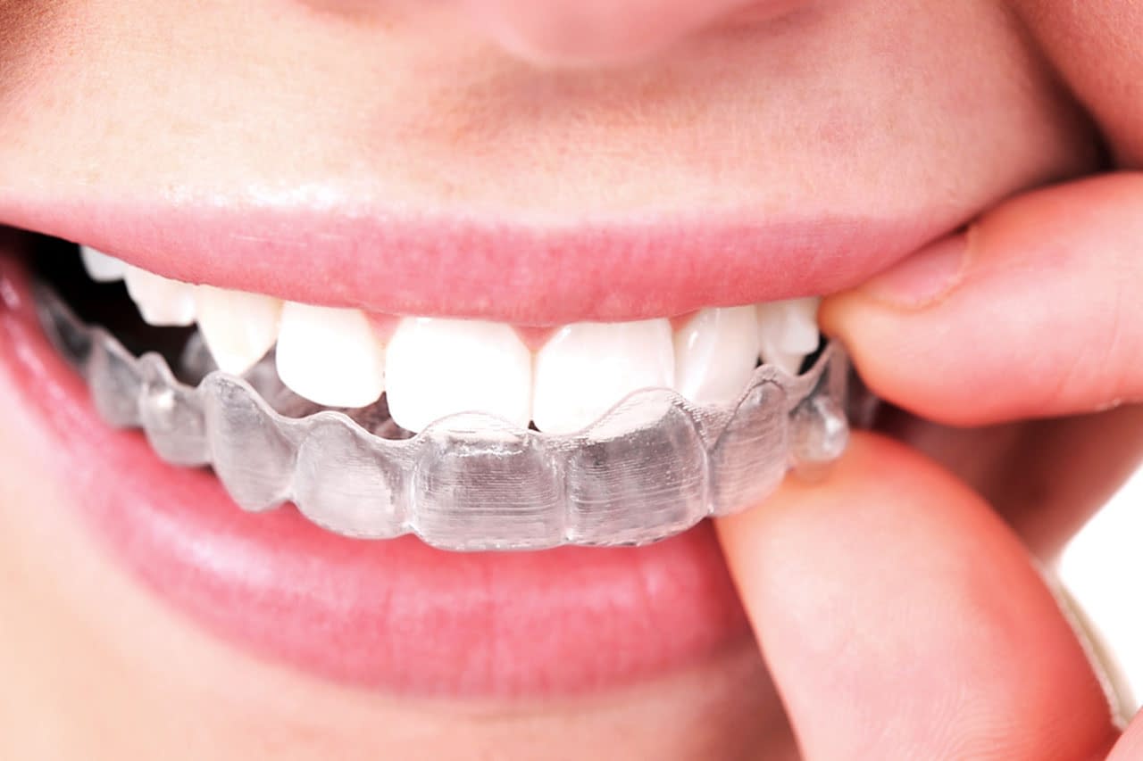 Concord Invisalign | Invisalign in Concord | Vermette Orthodontics