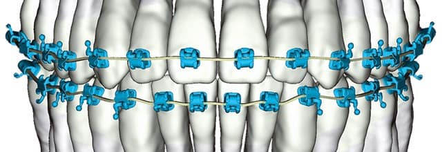 Advances in Orthodontic Treatment | Vermette Orthodontics