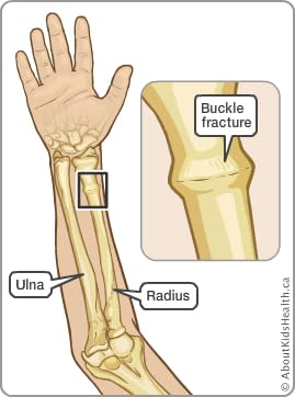 Ask An Orthopedist: Buckle Fracture | Azalea Orthopedics